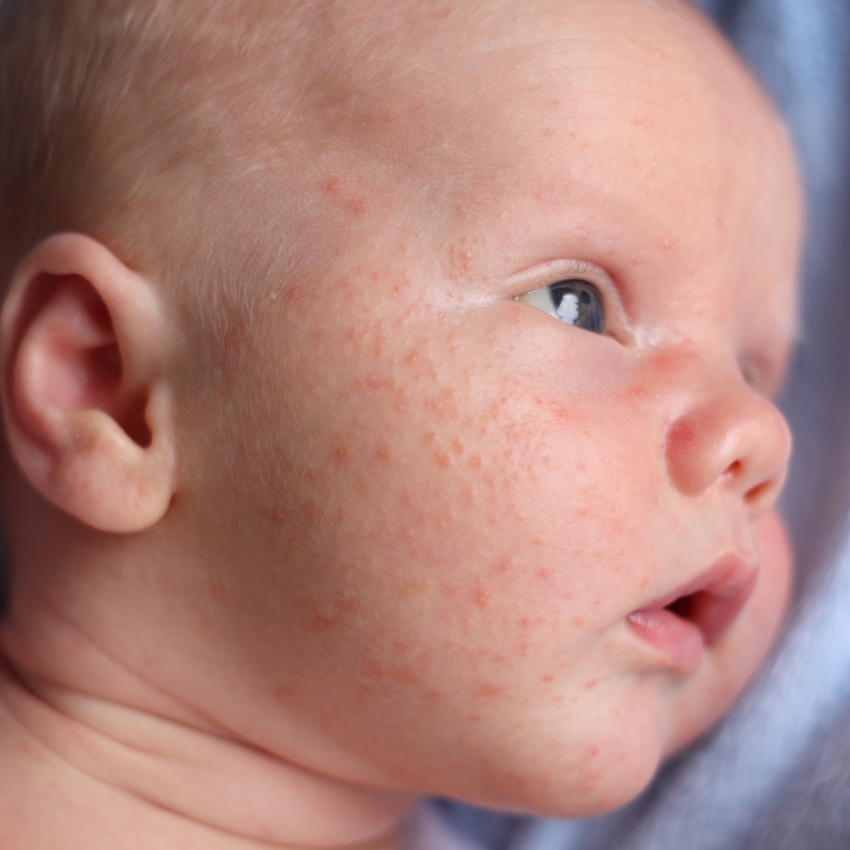 6 Perguntas E Respostas Sobre Acne Neonatal 6 Perguntas E Respostas Sobre Acne Neonatal