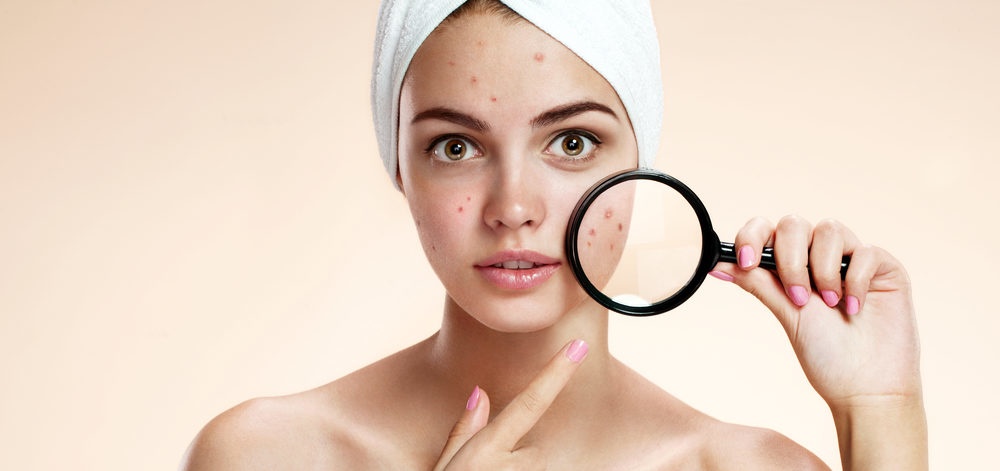 Isto é o que precisa saber e fazer para ver-se livre da acne (de vez)